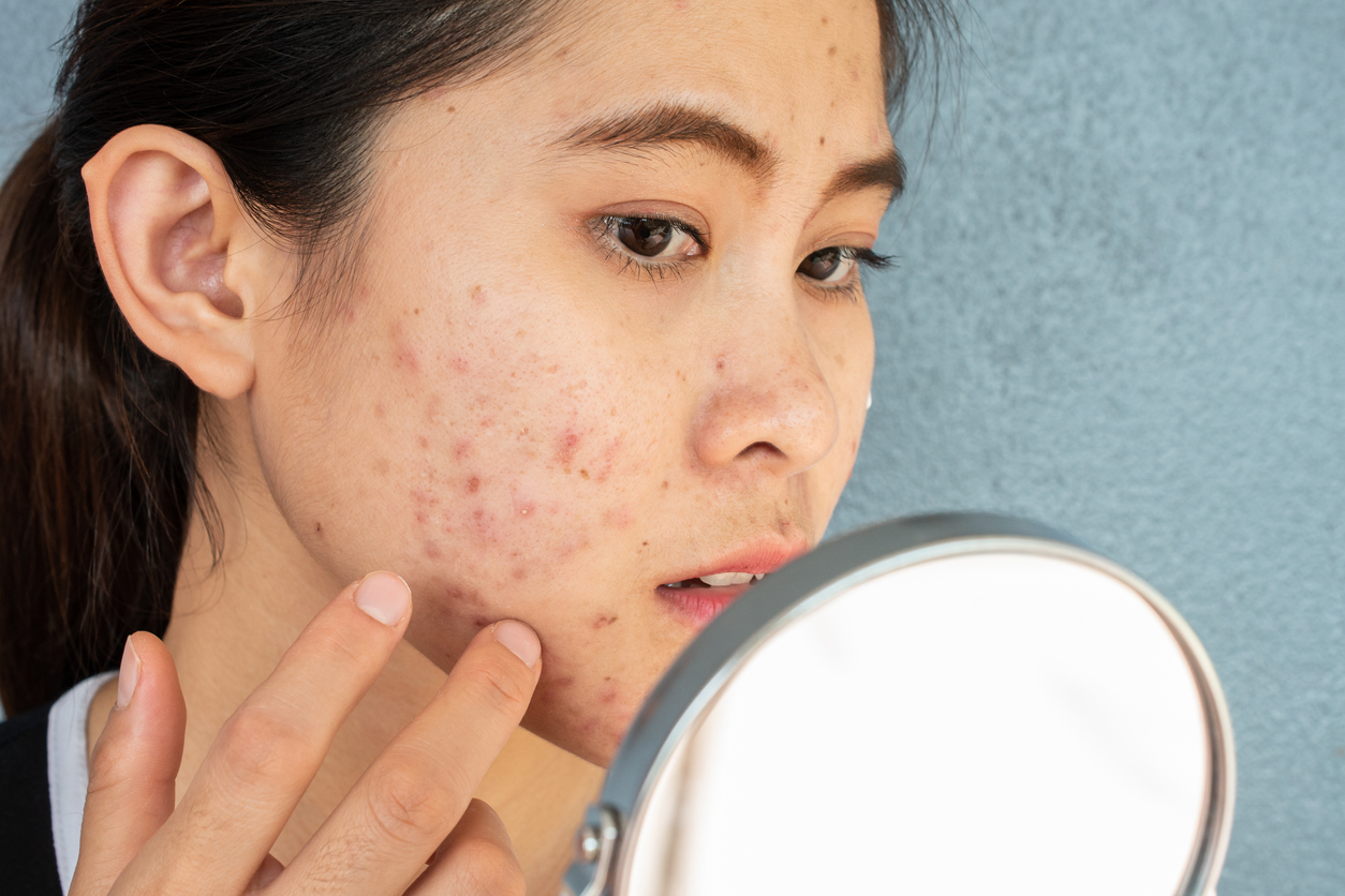 6 types of acne and how best to treat them - InstantScripts